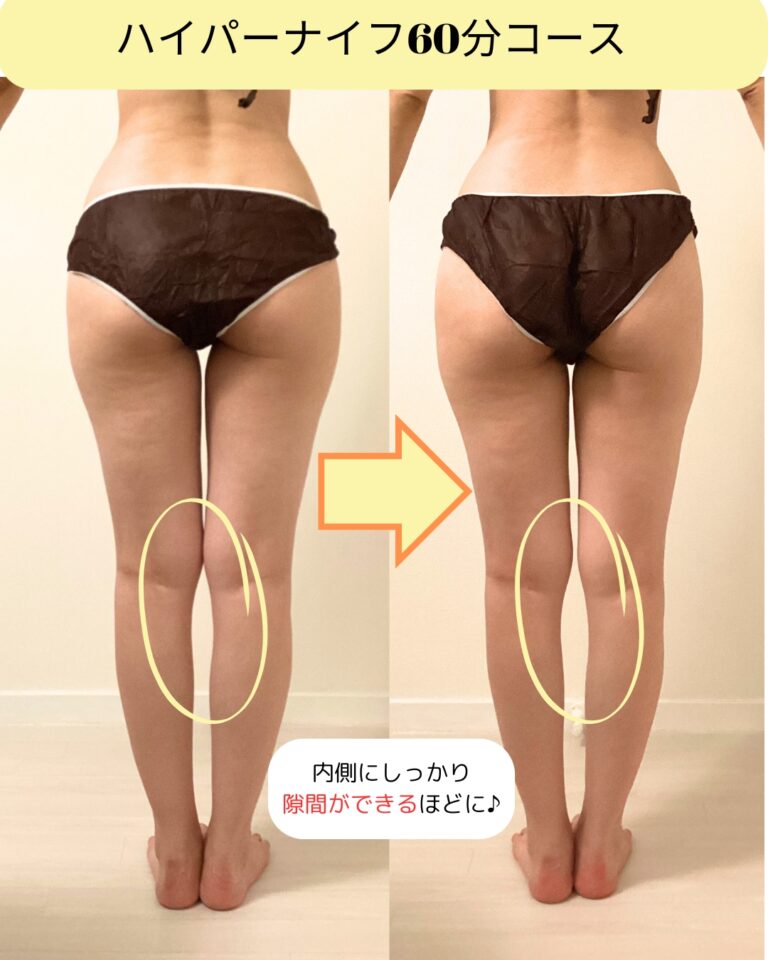 ハイパーナイフ60分で膝回りスッキリ！ビフォーアフター | 脚やせ専門ボディメイクB-CHERISH