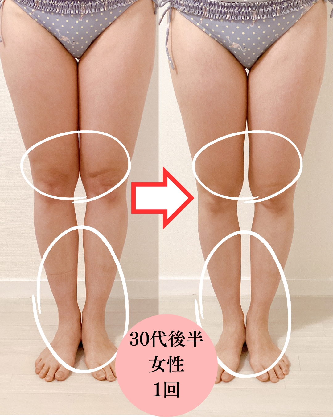 30代後半女性ビフォーアフター／内もも引き締めでスリムアップ！ | 脚やせ専門ボディメイクB-CHERISH